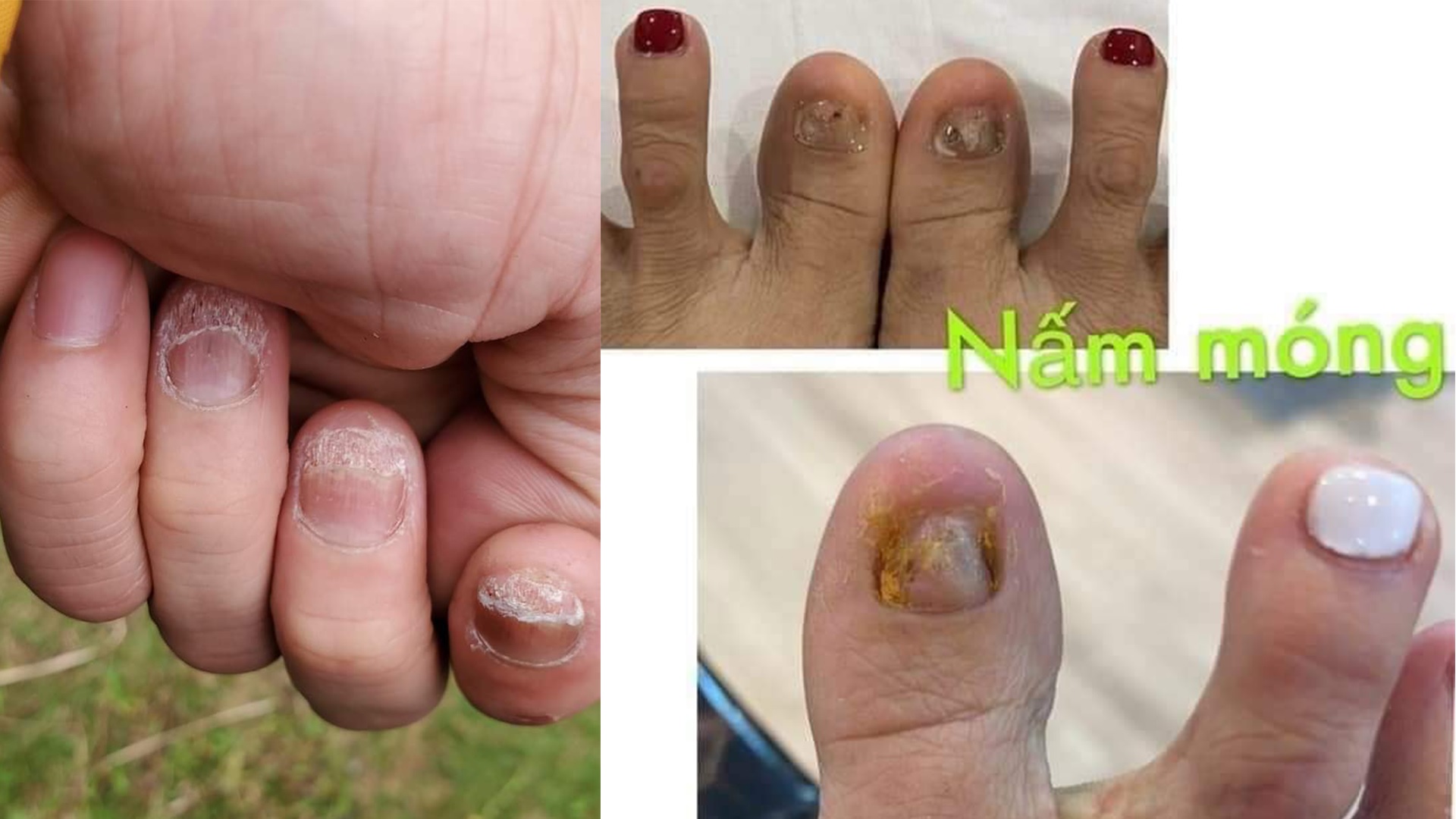#1 Cách trị nấm móng tay bằng dân gian và thuốc đặc trị